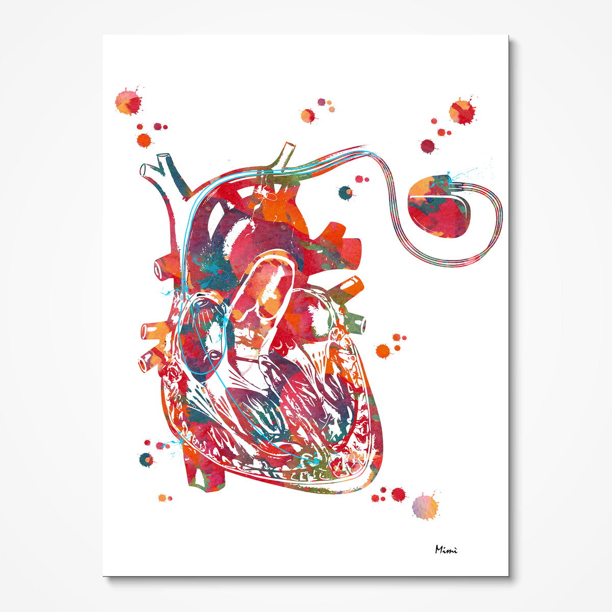 Heart Pacemaker Anatomy Print Cardiac External Pacemaker – MimiPrints ...