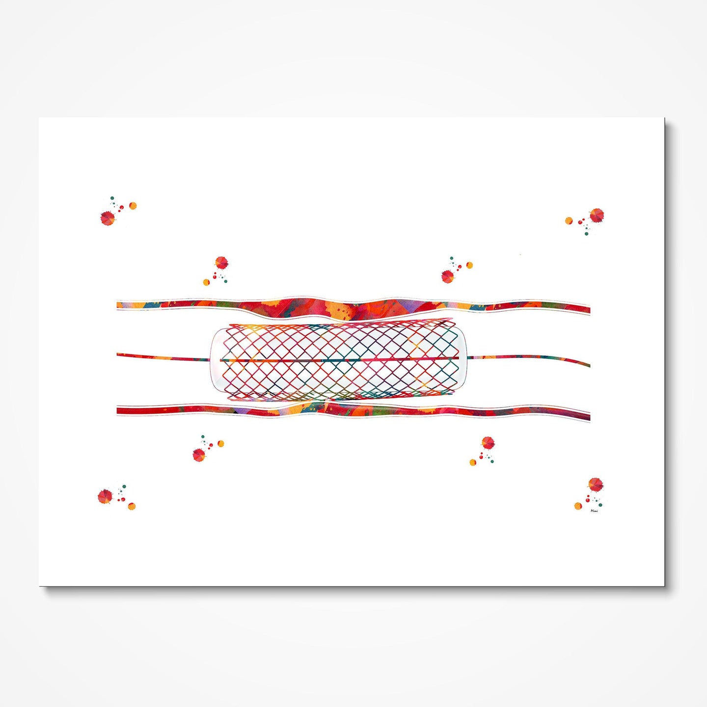 Coronary Stent Anatomy Print – MimiPrints Anatomy Art Prints And ...
